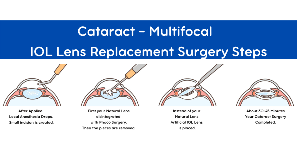 Monofocal Cataract Surgery - Lens Replacement - Akıllı Lazer Göz Merkezi