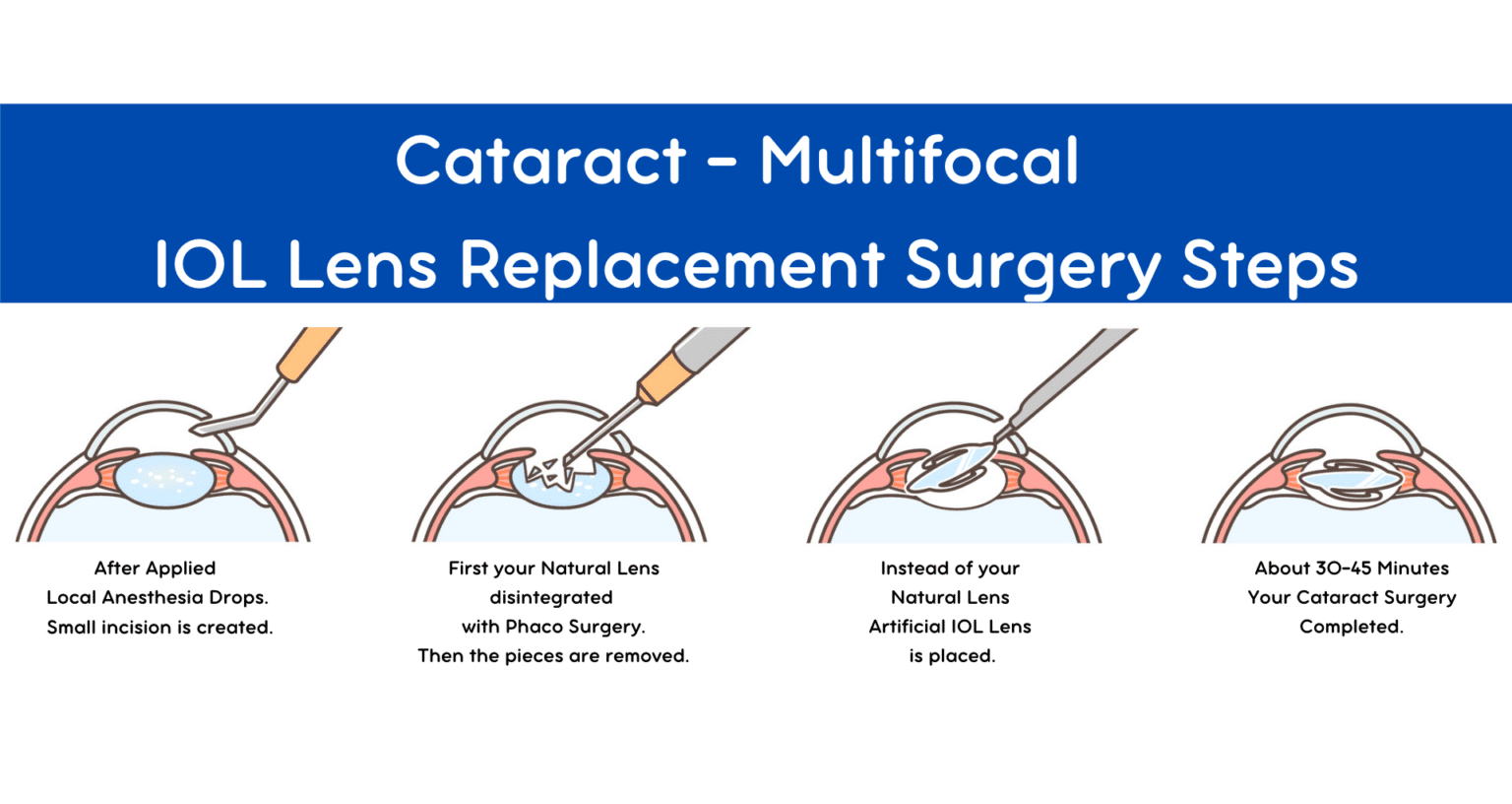 Multifocal Cataract Surgery Akıllı Lazer Göz Merkezi