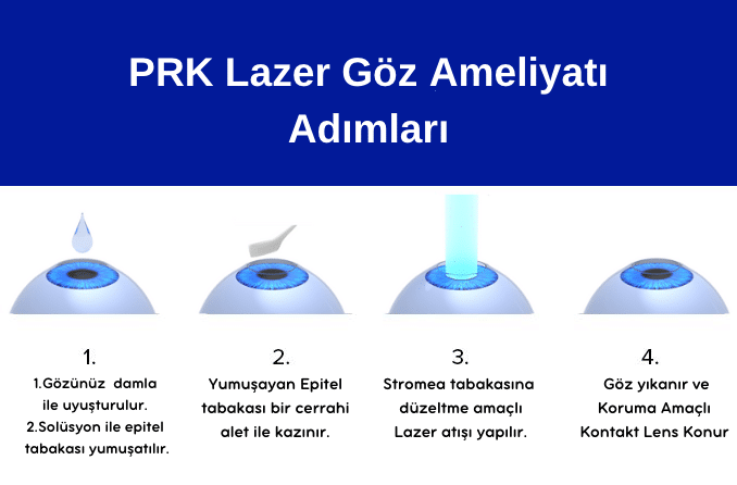 PRK Lazer Göz Ameliyatı Hakkında - LASIK - No-Touch - LASEK