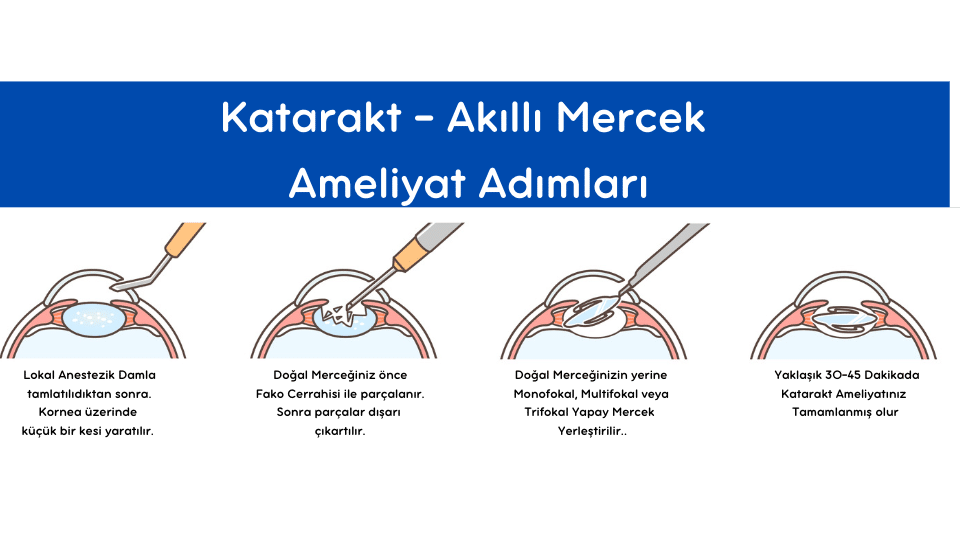 Akıllı Mercek ile Katarakt Ameliyatları - 35 Yıllık Tecrübe
