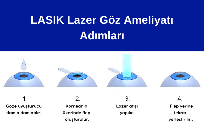 Lazer Göz Ameliyatı LASIK yöntemi ile aynı gün net ve hızlı görüş